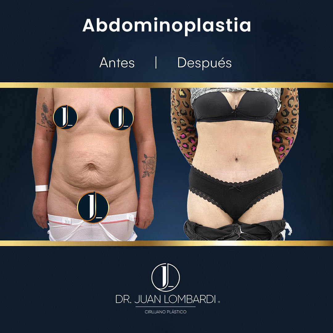 Abdominoplastia mediante Bono PAD – Dr. Juan José Lombardi